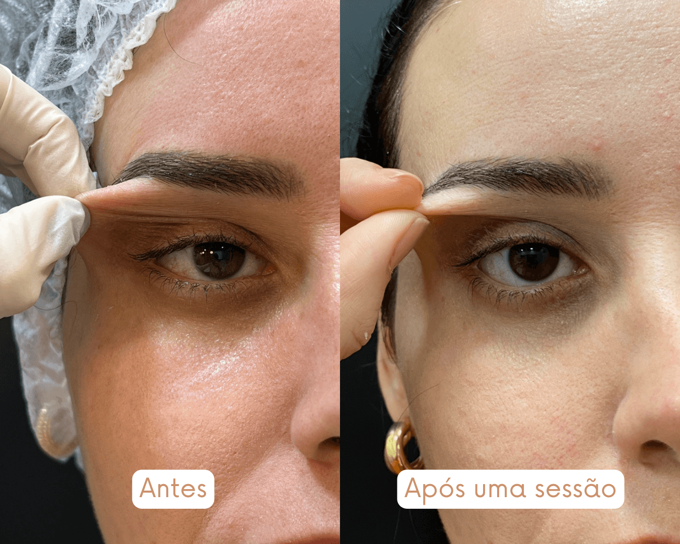 Conheça o Jato de Plasma | Clinica de Estética SP - Zay Estética